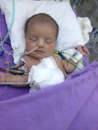 6. Modifiye Mee shunt ameliyatı Suriye'li Bebek Rodi'ye başarıyla ...